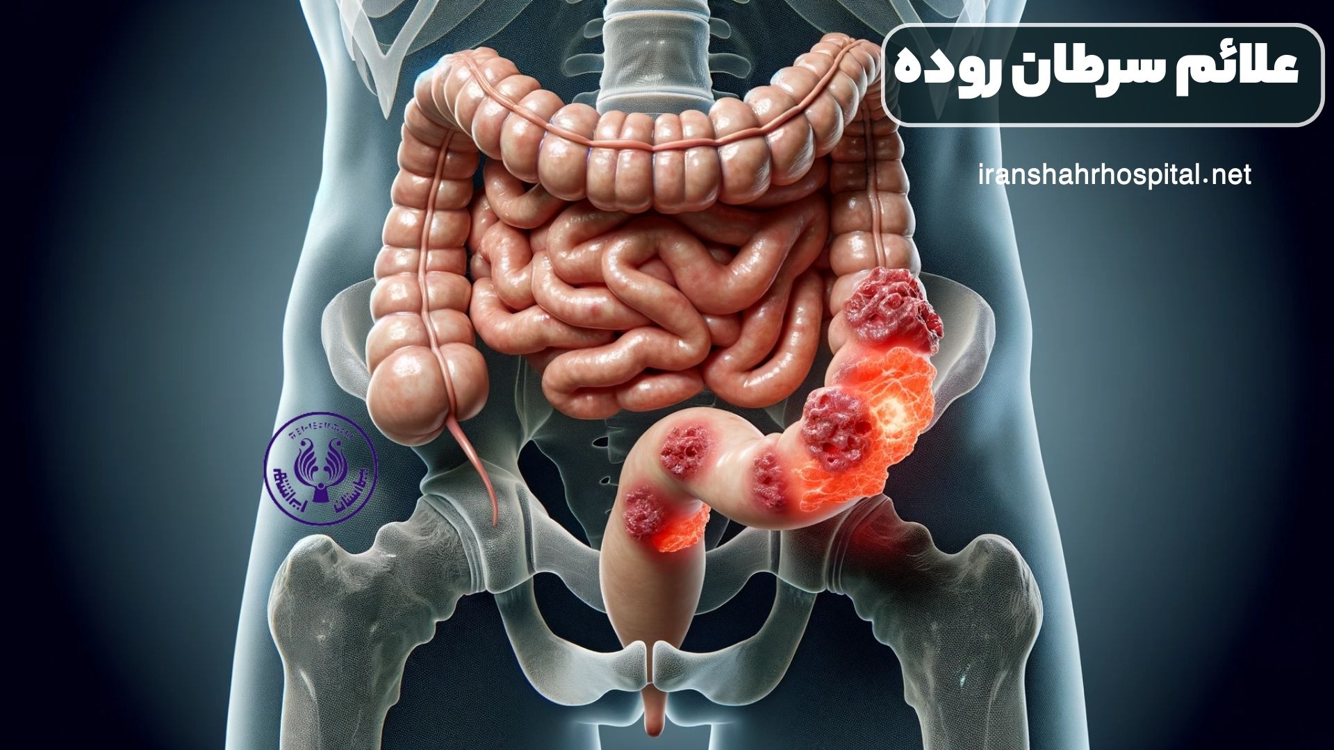 علائم سرطان روده چیست؟ علائم اولیه تا پیشرفته 🎗️